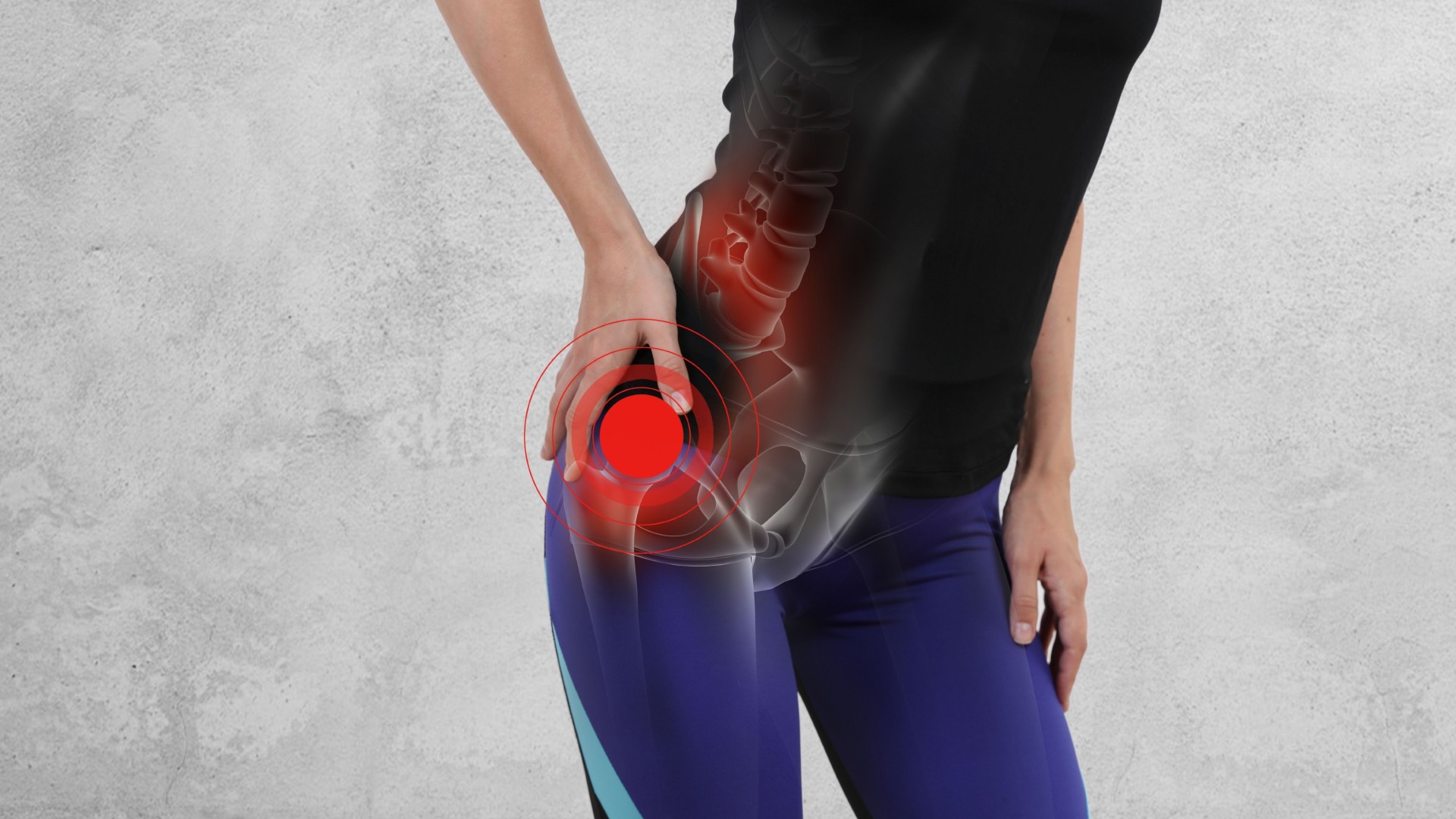 3 ways to treat Hip Bursitis at home in Geelong – Shannon Avenue ...