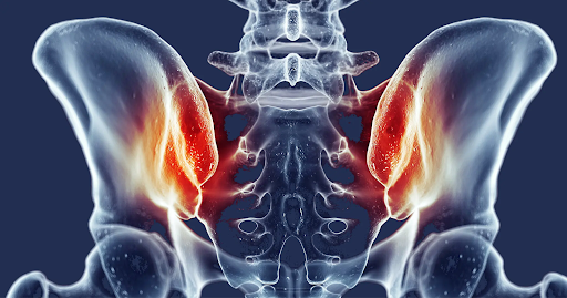 Understanding Sacroiliac Joint (SIJ) Pain: Insights from a Geelong ...